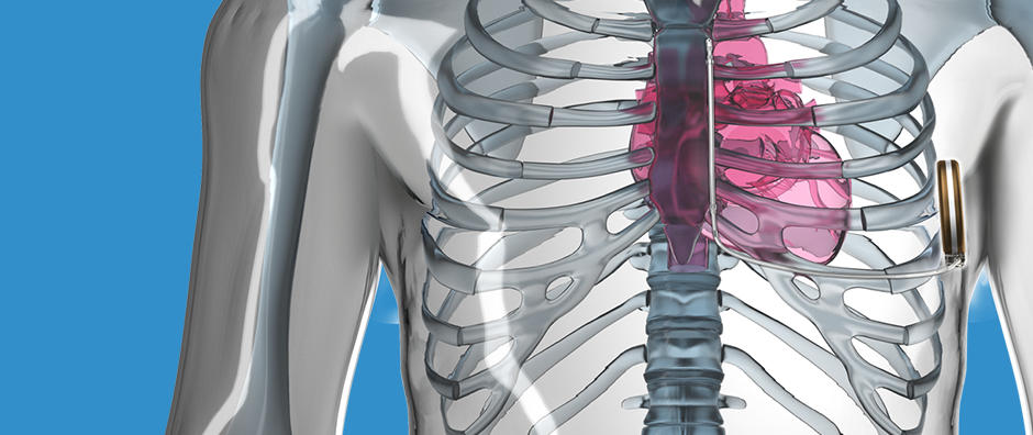 S-ICD - Learn about the subcutaneous ICD difference